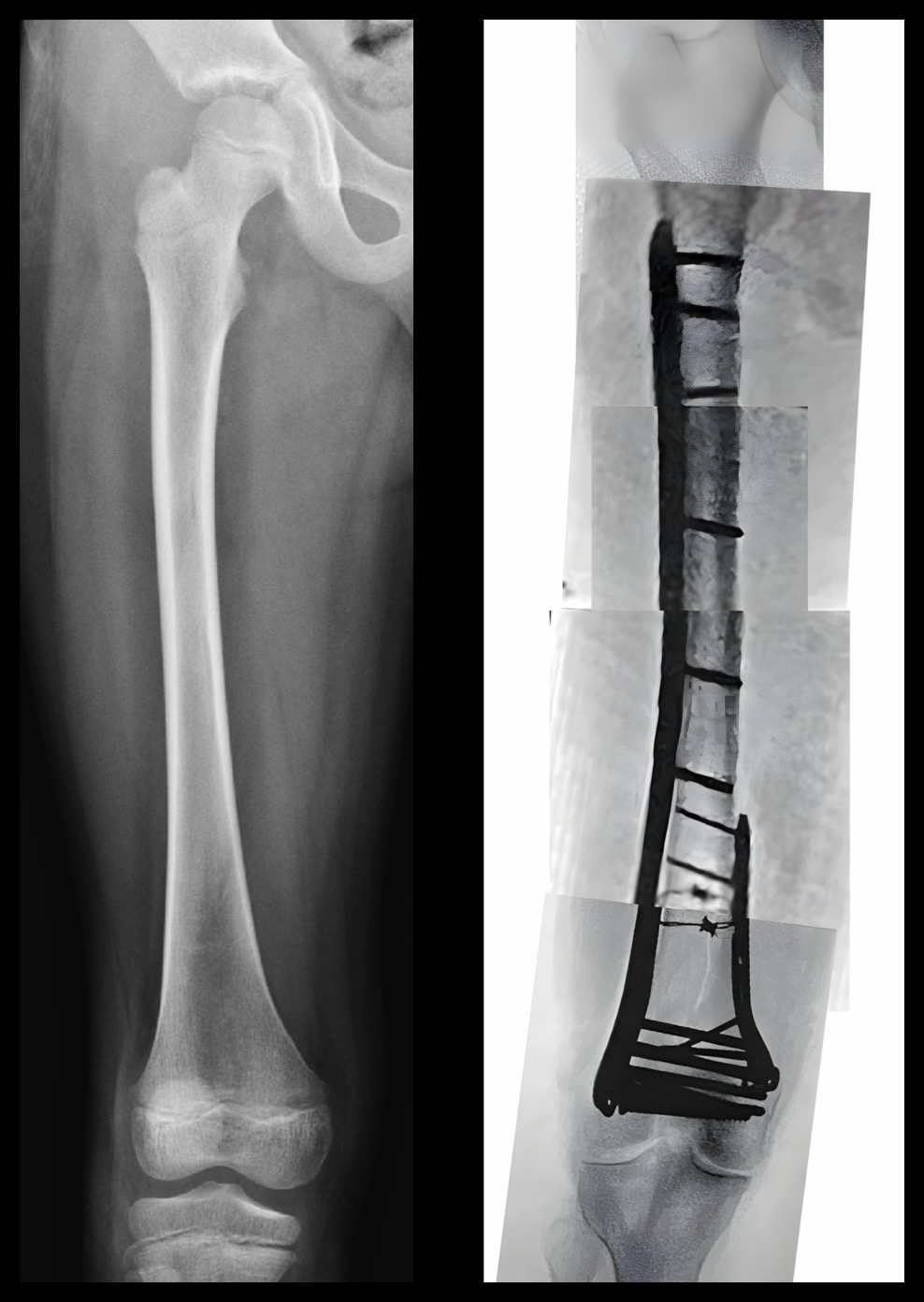 Someone’s good femur. My titanium femur. by John Falconer · 365 Project